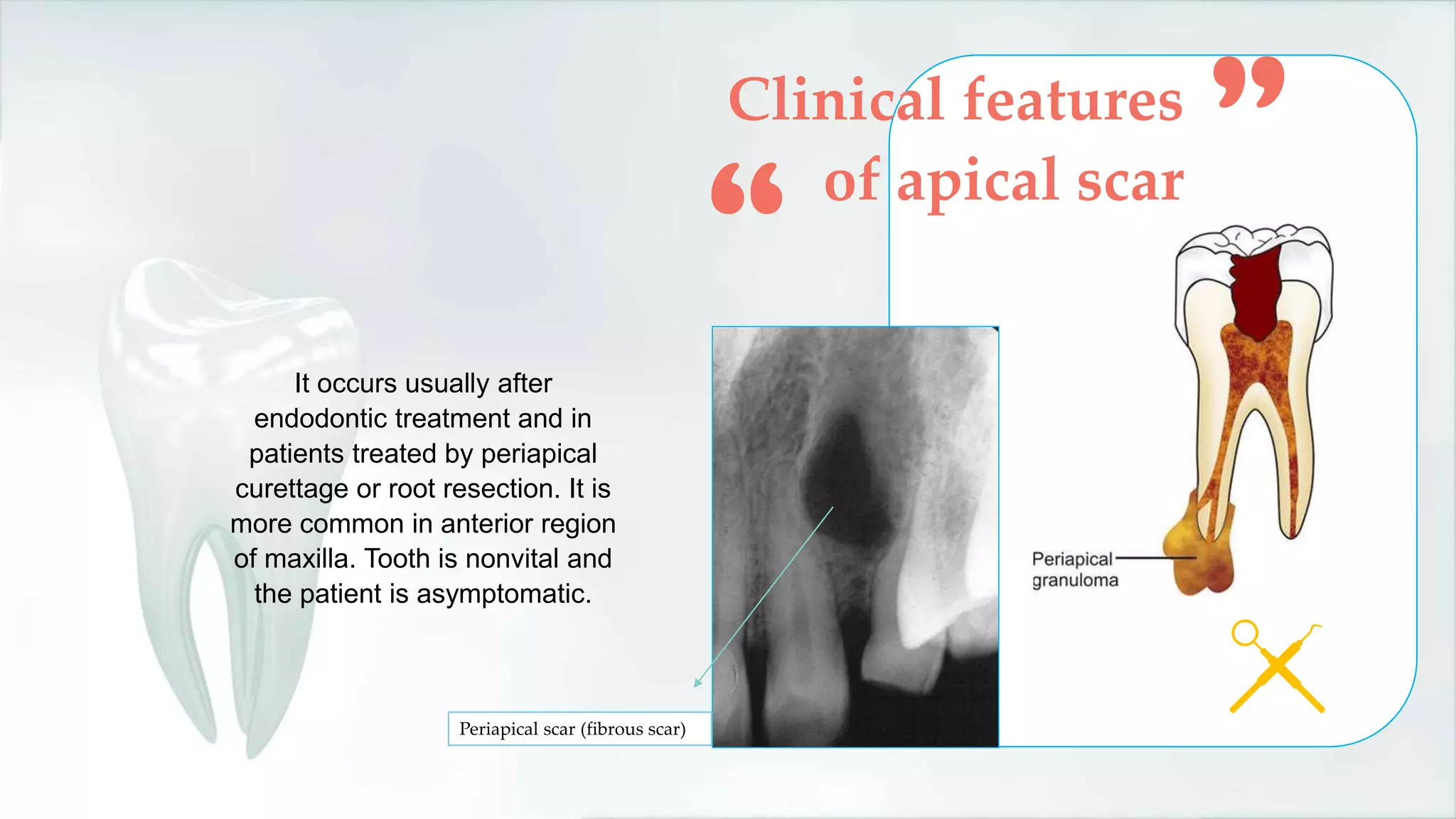 Pathology of pulp and its sequels | PPTX