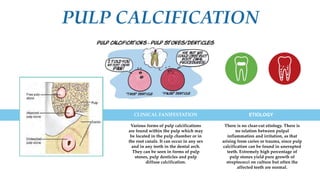 Pathology of pulp and its sequels | PPTX