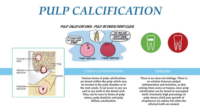 Pathology of pulp and its sequels | PPTX | Dental Health | Diseases and ...