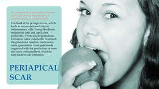 Pathology of pulp and its sequels | PPTX