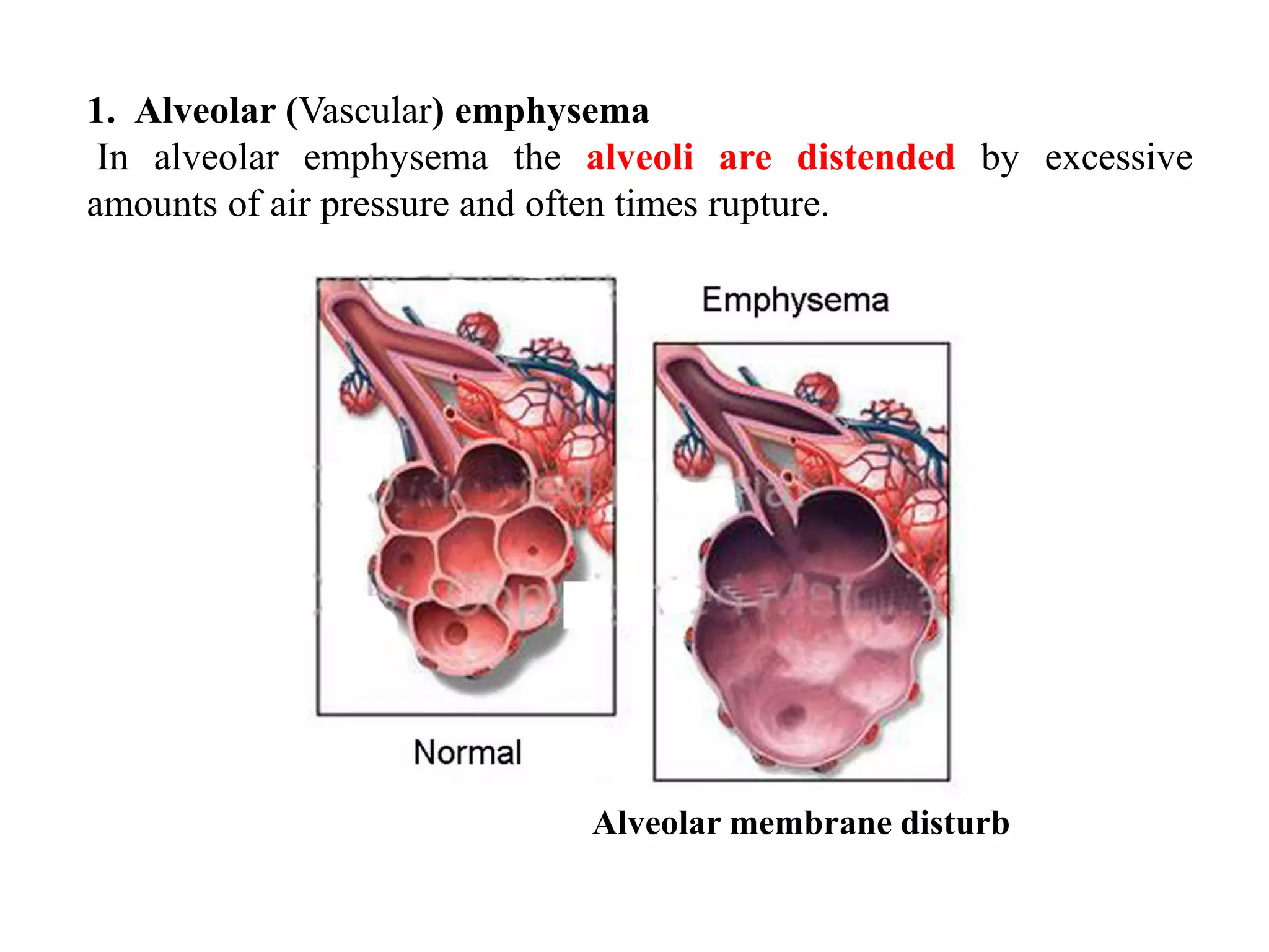 Pathology of respiratory system | PDF