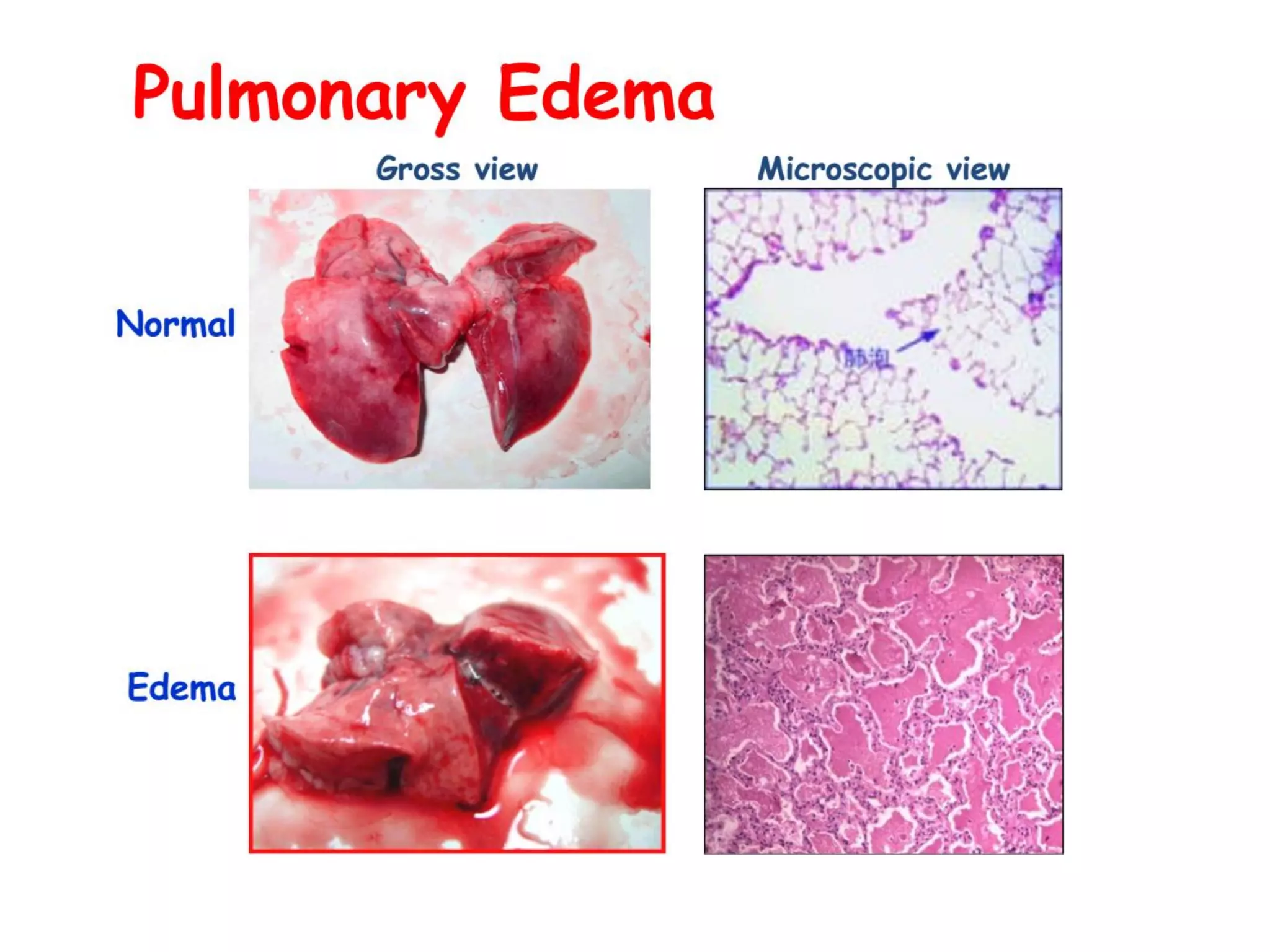 Pathology of respiratory system | PDF