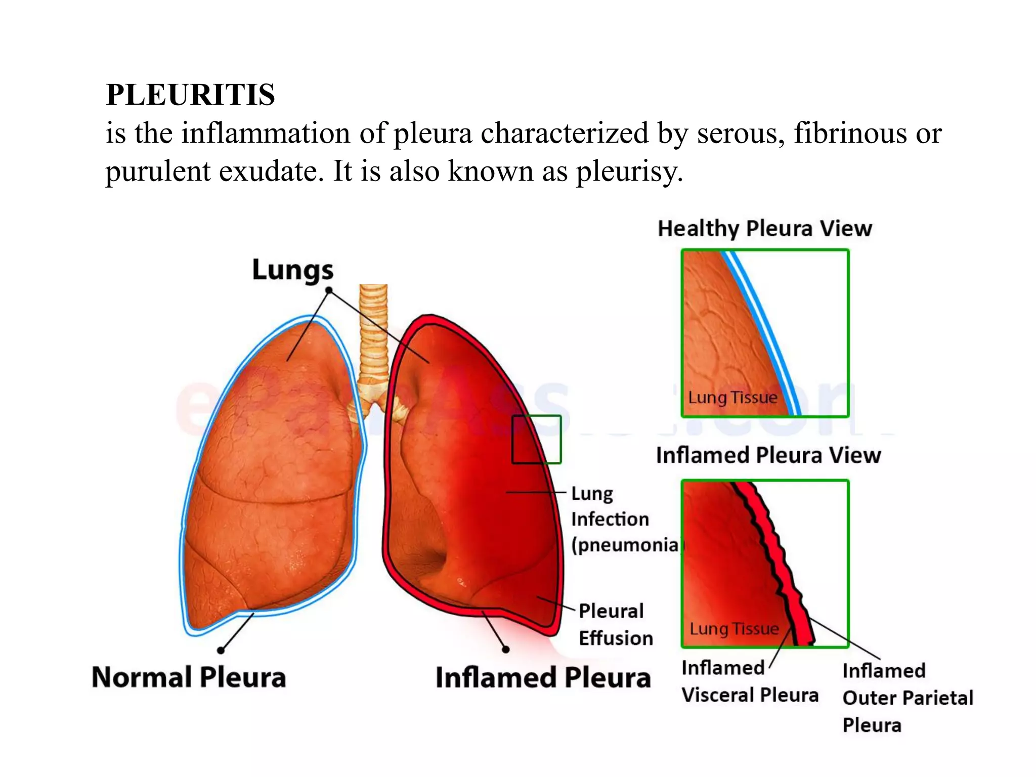 Pathology of respiratory system | PDF