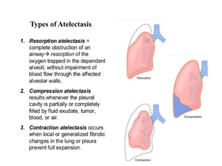 Pathology of respiratory system | PDF
