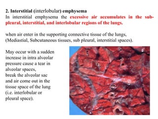 Pathology of respiratory system | PDF