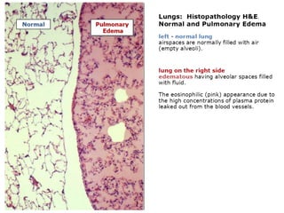 Pathology of respiratory system | PDF