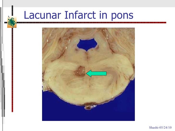 Pathology+of+stroke