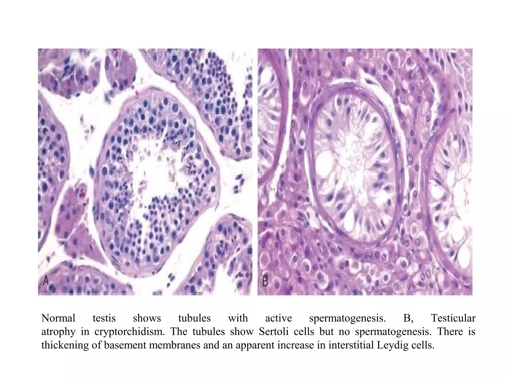 Pathology of testis | PPT
