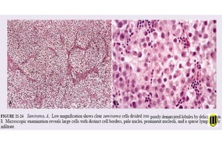 Pathology of testis | PPT