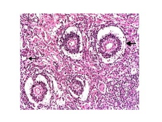 Pathology of testis | PPT