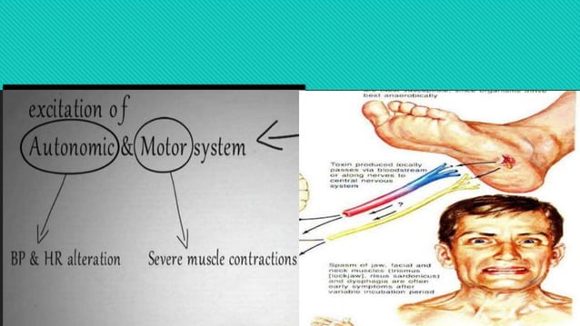 Pathology of tetanus by muhammad arham | PPT