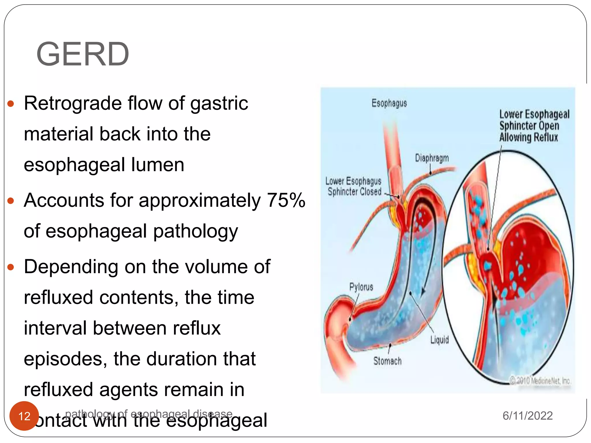 PATHOLOGY OF THE ESOPHAGUS.pptx