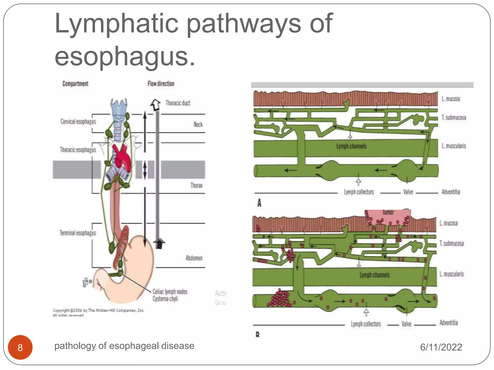 PATHOLOGY OF THE ESOPHAGUS.pptx
