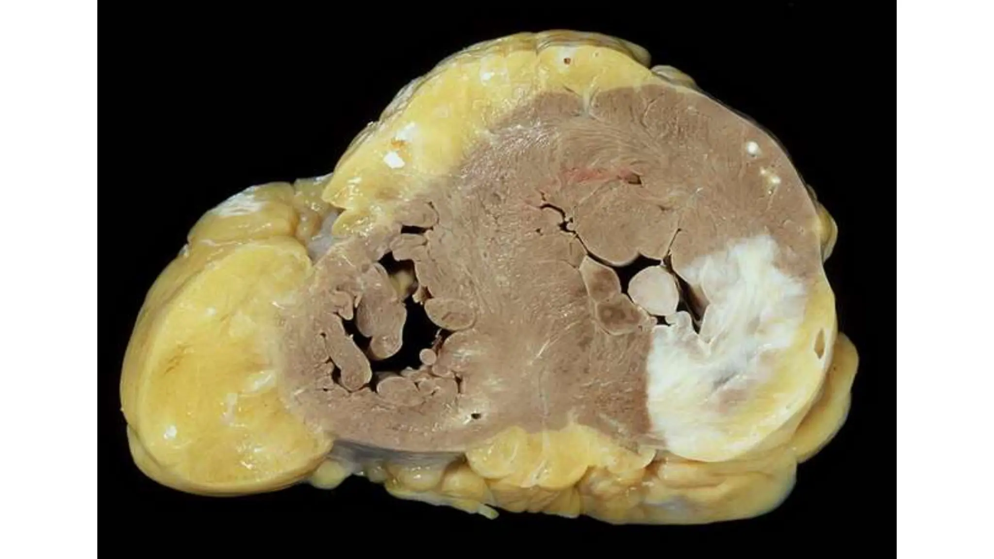 Pathology of the heart.. Disorders of heart | PPT