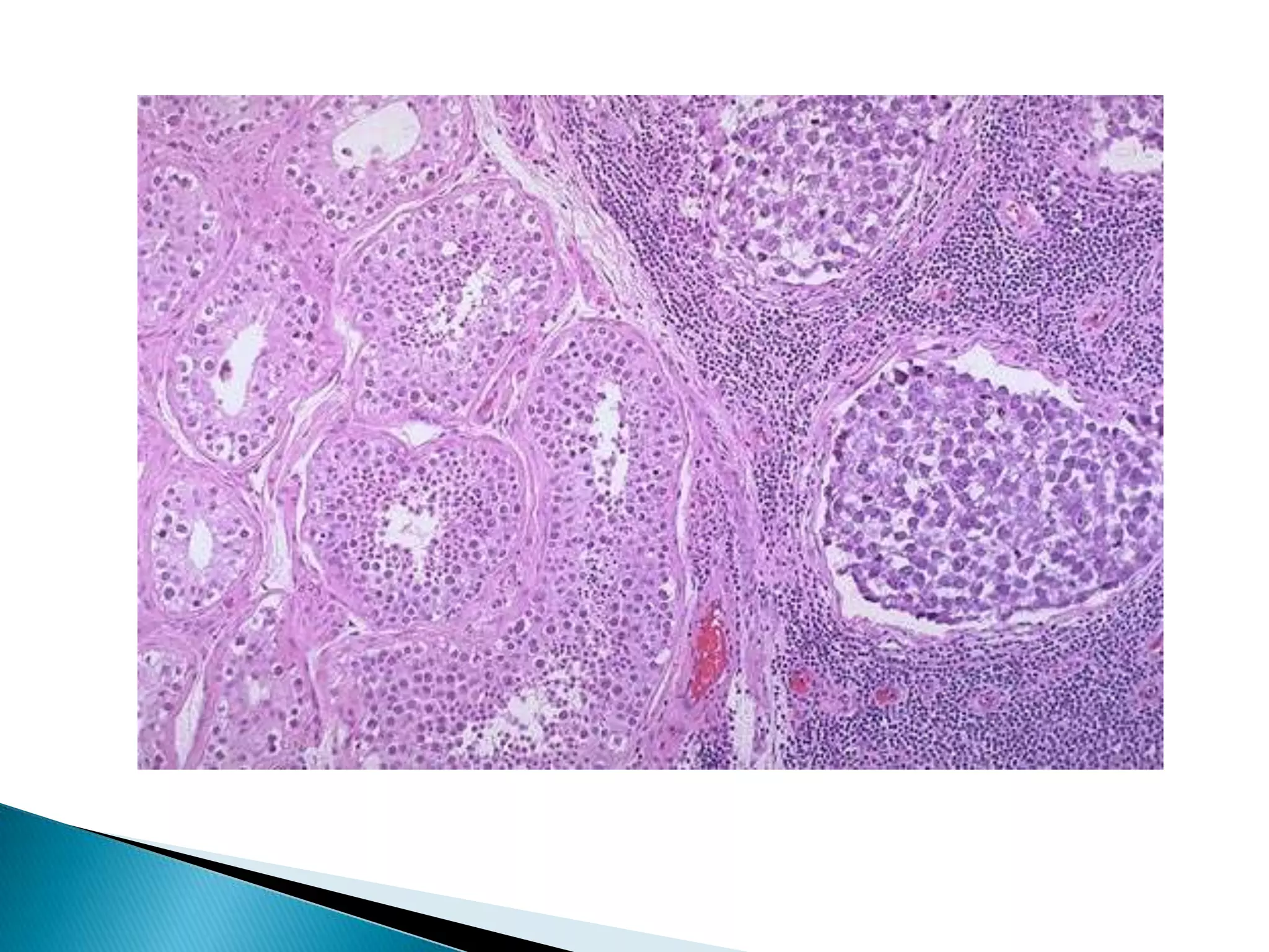 Pathology of the male genital tract | PPTX