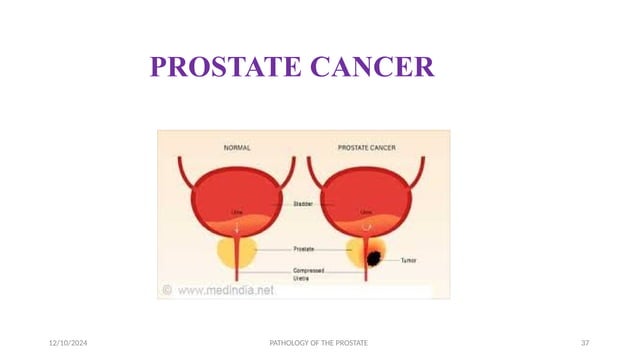 Pathology_of_the_Prostate[1].pptx and prostate ca | PPTX