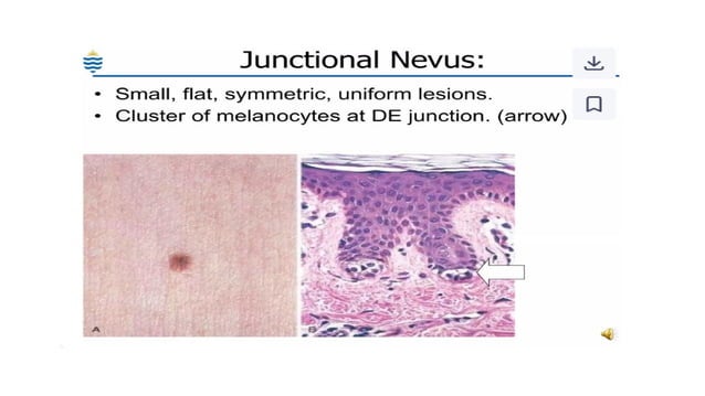 PATHOLOGY OF THE SKIN POWERPOINT PRESENTATION...... Lichen Planus ...