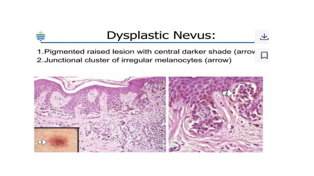 PATHOLOGY OF THE SKIN POWERPOINT PRESENTATION...... Lichen Planus ...