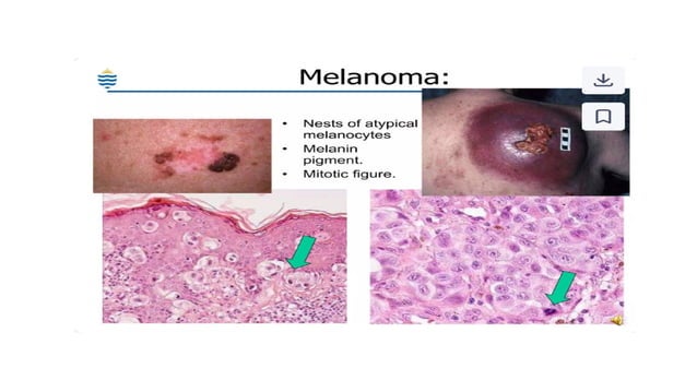 PATHOLOGY OF THE SKIN POWERPOINT PRESENTATION...... Lichen Planus ...