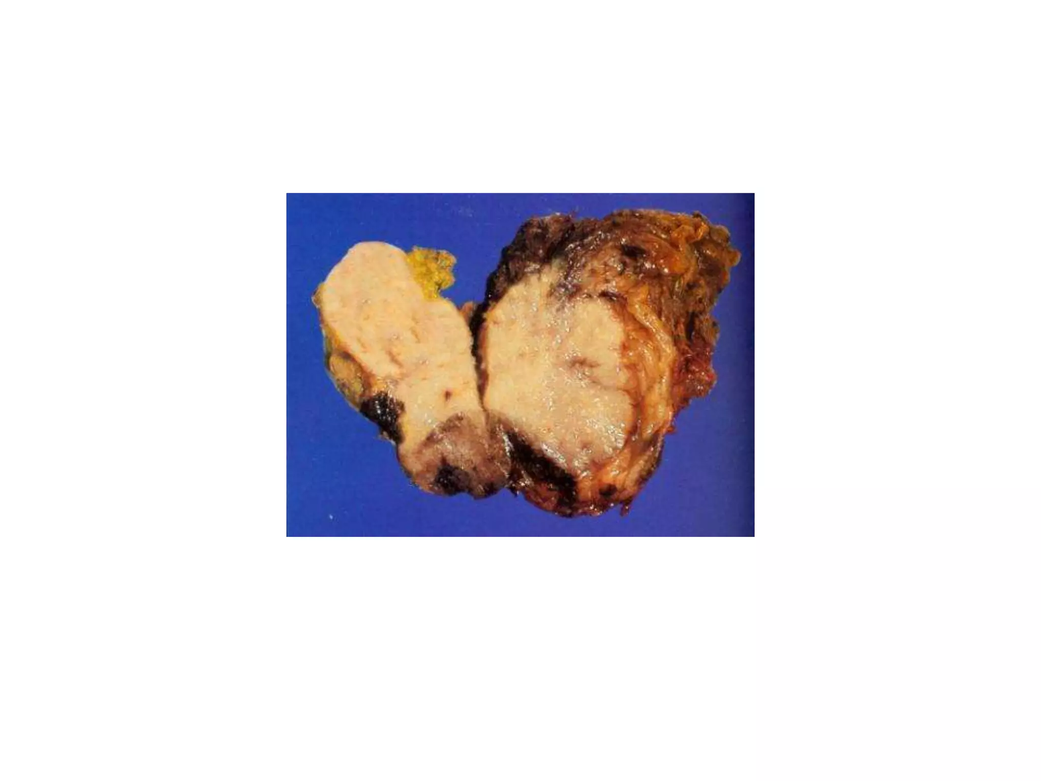 Pathology of thymus | PPTX