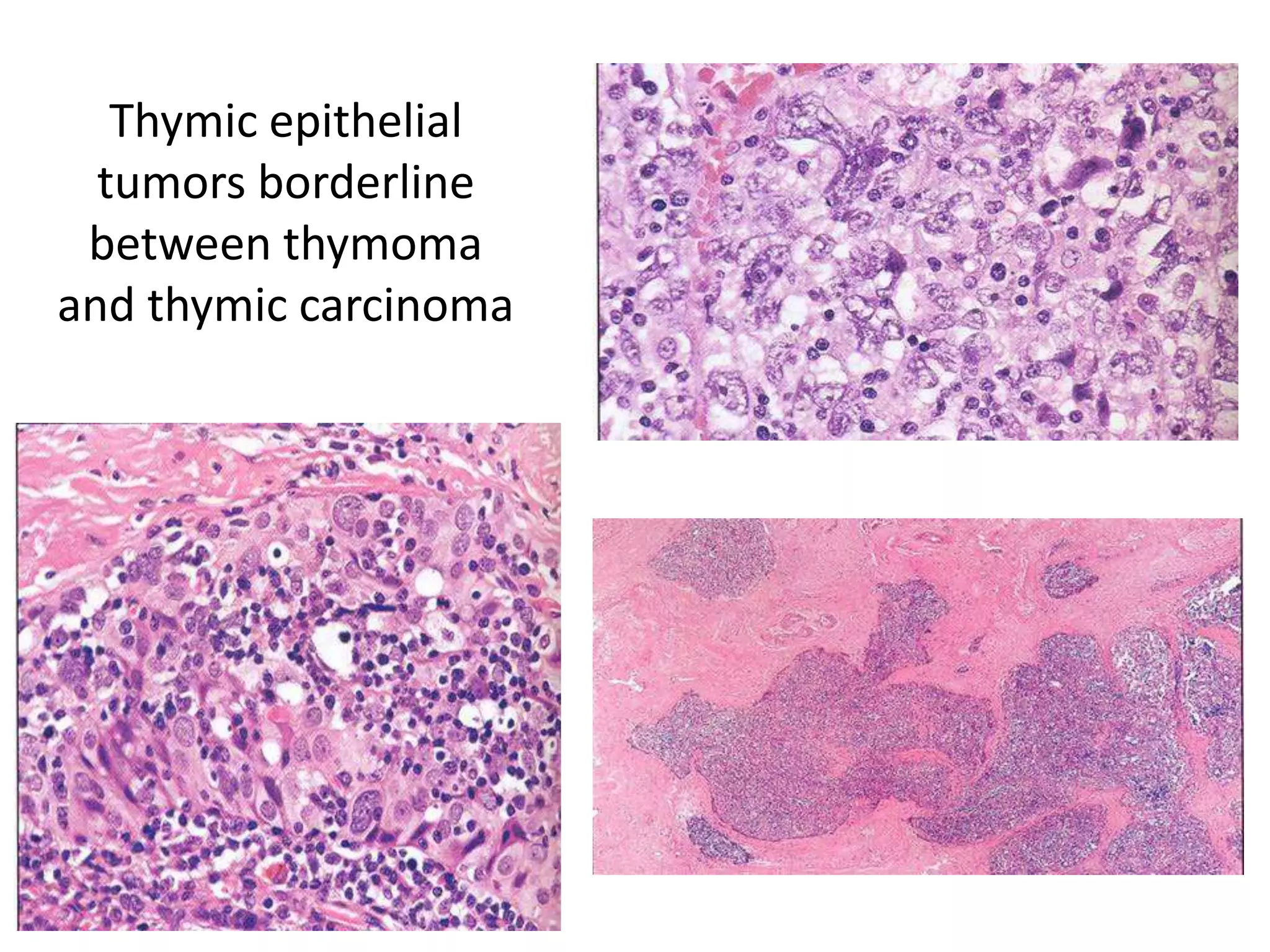Pathology of thymus | PPTX