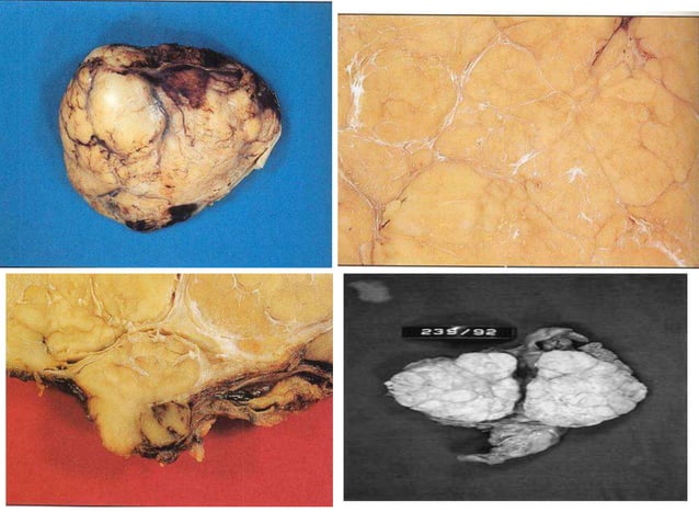 Pathology of thymus | PPTX