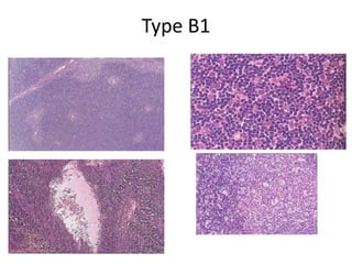 Pathology of thymus | PPTX
