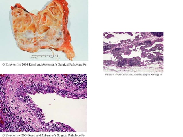Pathology of thymus | PPTX