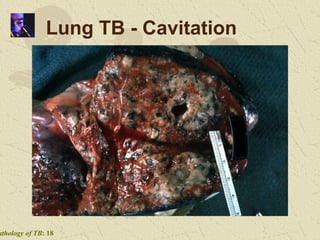 Pathology of Tuberculosis12345567778.ppt