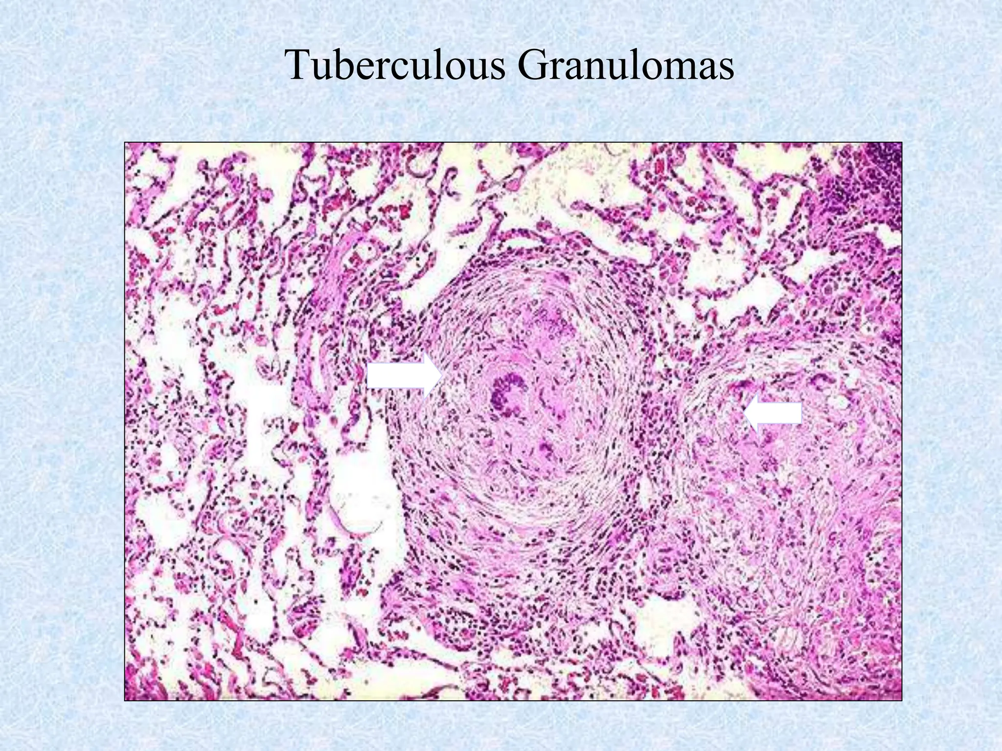 Pathology of tuberculosis of lung | Jindal Chest Clinic | PPT ...