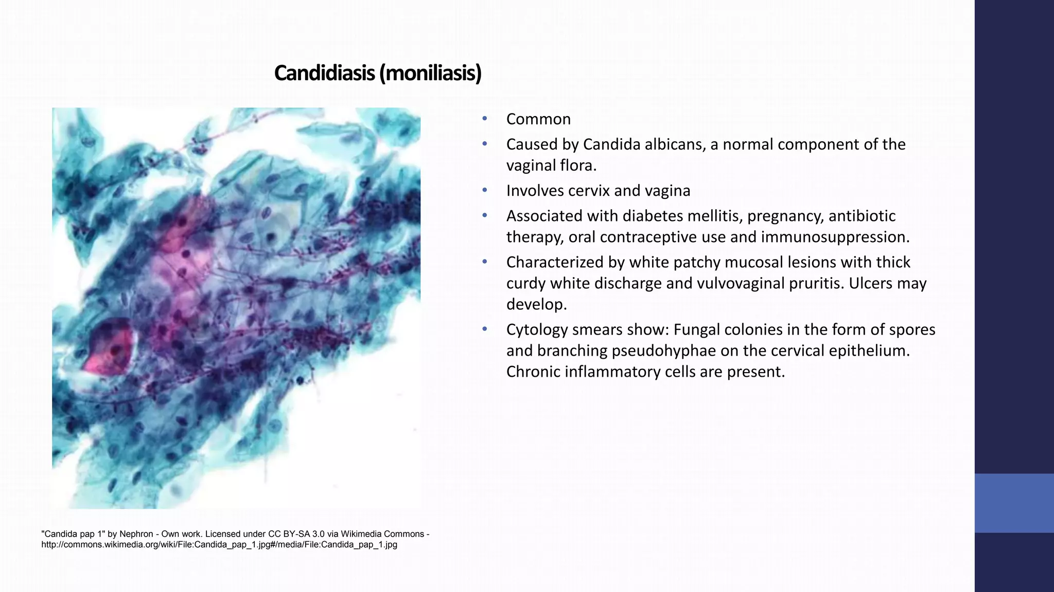 Pathology of uterine cervix 2018 Sufia Husain | PPTX