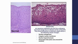 Pathology of uterine cervix 2018 Sufia Husain | PPTX