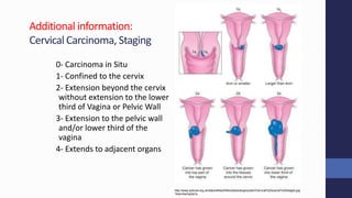 Pathology of uterine cervix 2018 Sufia Husain | PPTX
