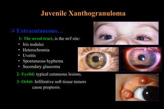 Juvenile Xanthogranuloma Iris