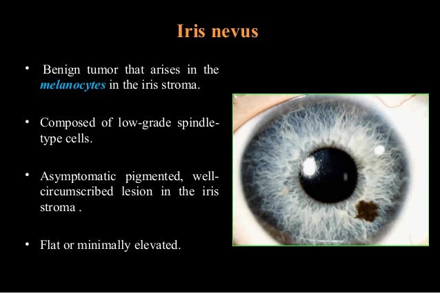 Pathology of uvea