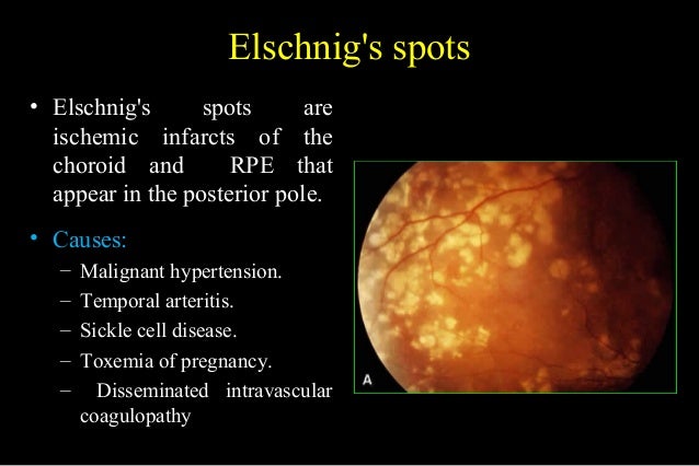 Pathology of uvea