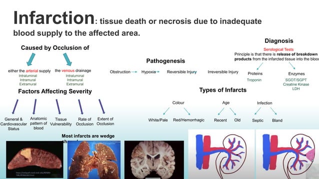 Thrombosis, Embolism, Infarction, Coagulation & Shock . pptx | PPT
