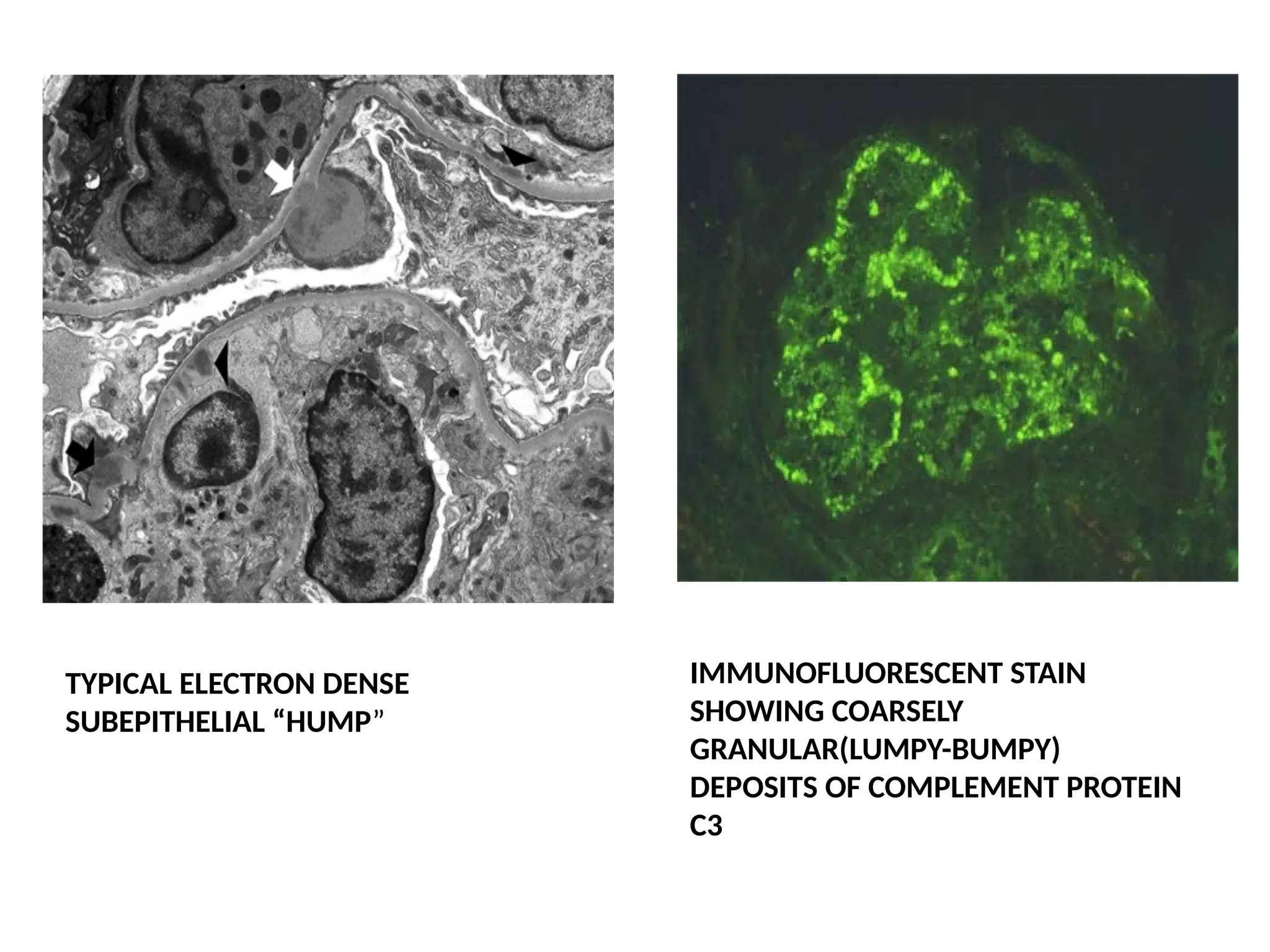 Acute Proliferative Glomerulonephritis and Rapidly Progressive ...