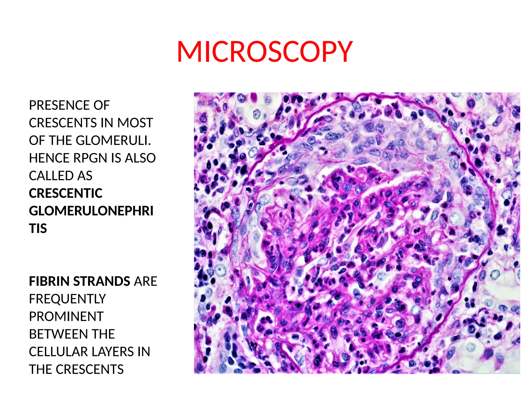 Acute Proliferative Glomerulonephritis and Rapidly Progressive ...