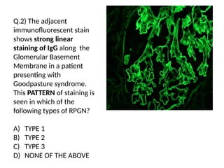 Acute Proliferative Glomerulonephritis and Rapidly Progressive ...