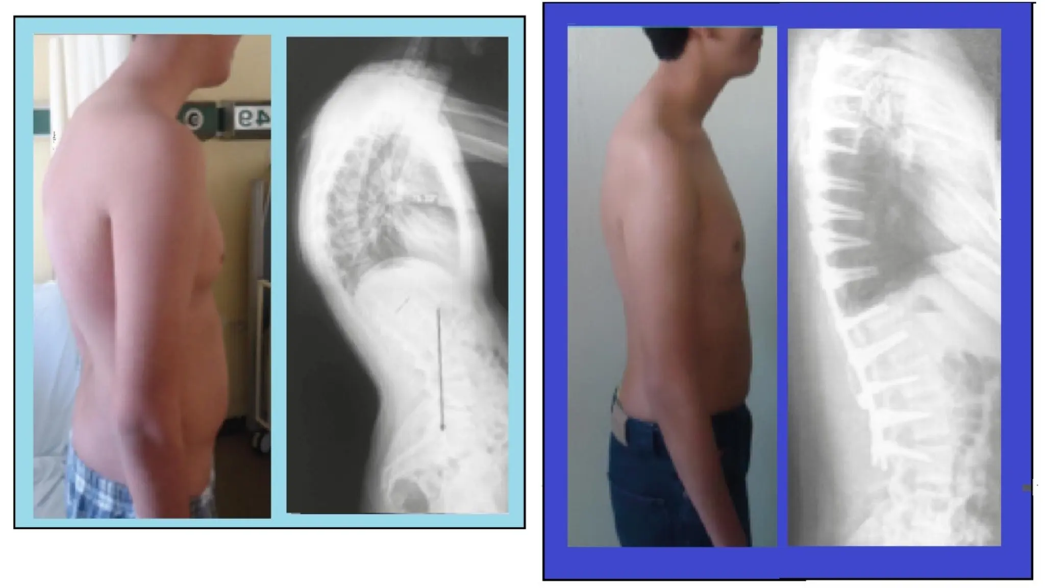 Pathologies in thoracic spine education.pptx