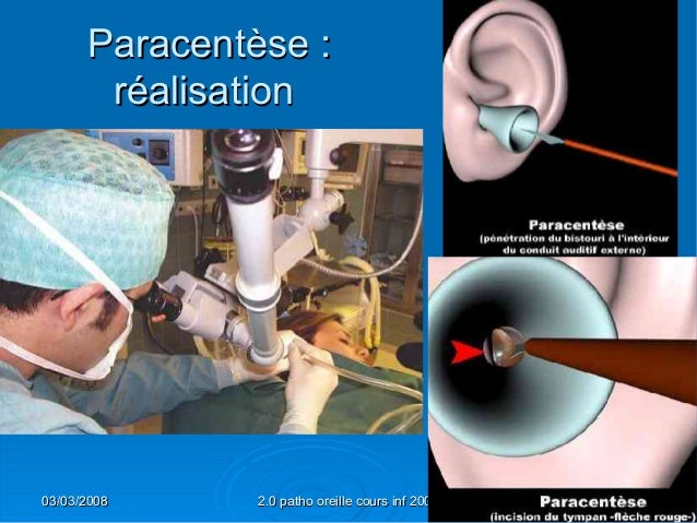 paracentèse - définition - C'est quoi