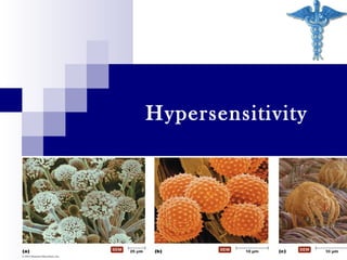 Hypersensitity, And Types of Hypersensitivity I, II, III, IV | PPT