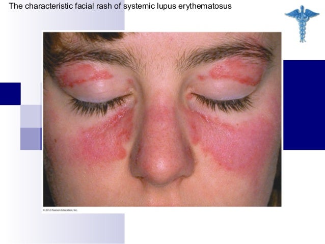 Hypersensitity, And Types of Hypersensitivity I, II, III, IV