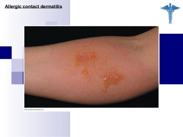 Hypersensitity, And Types of Hypersensitivity I, II, III, IV