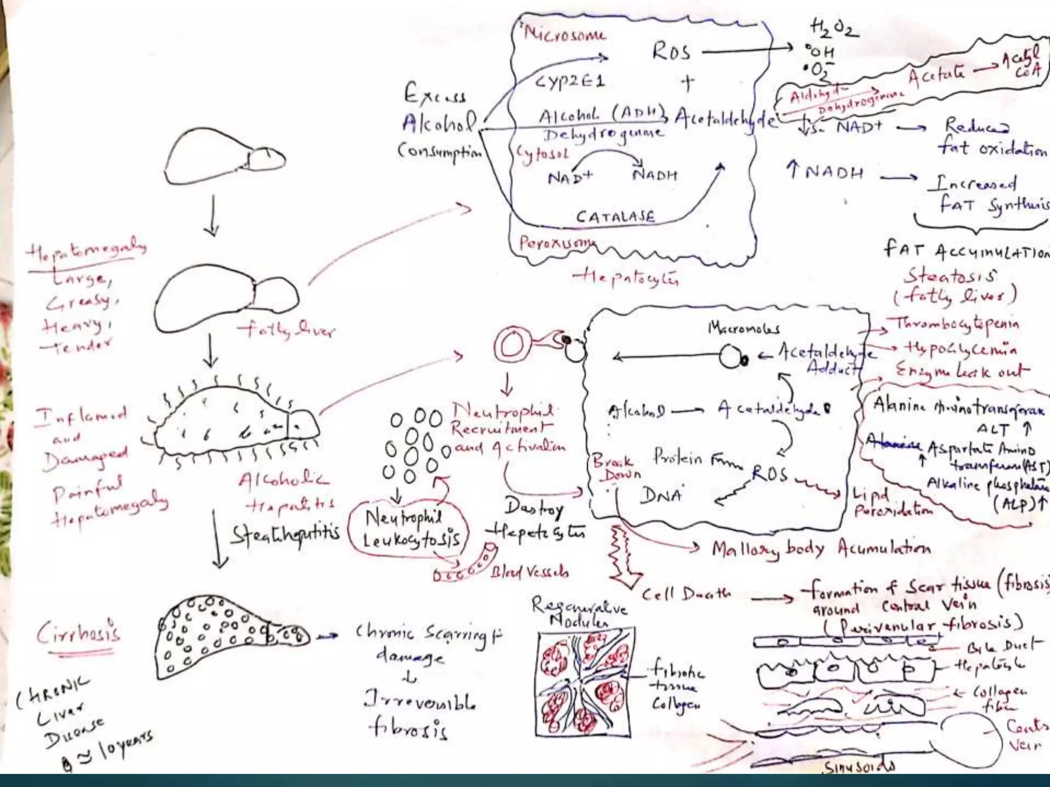 Pathophysiology of alcoholic liver disease | PPTX