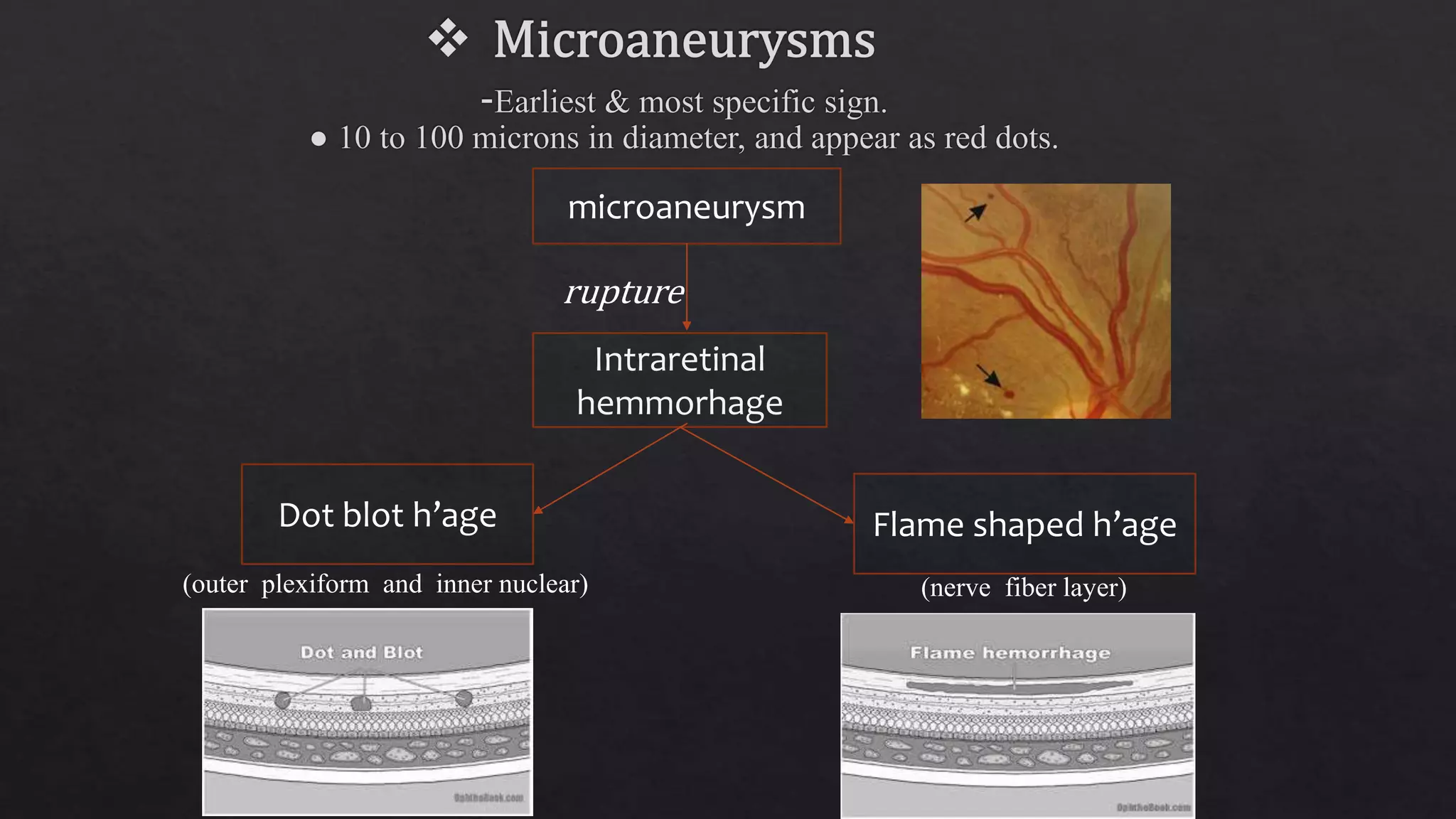 Pathophysiology of Diabetic retinopathy | PPTX