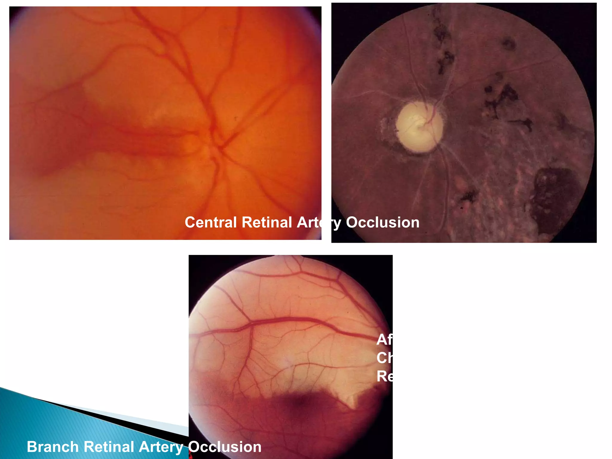 Retinal lesions Pathophysiology | PPT
