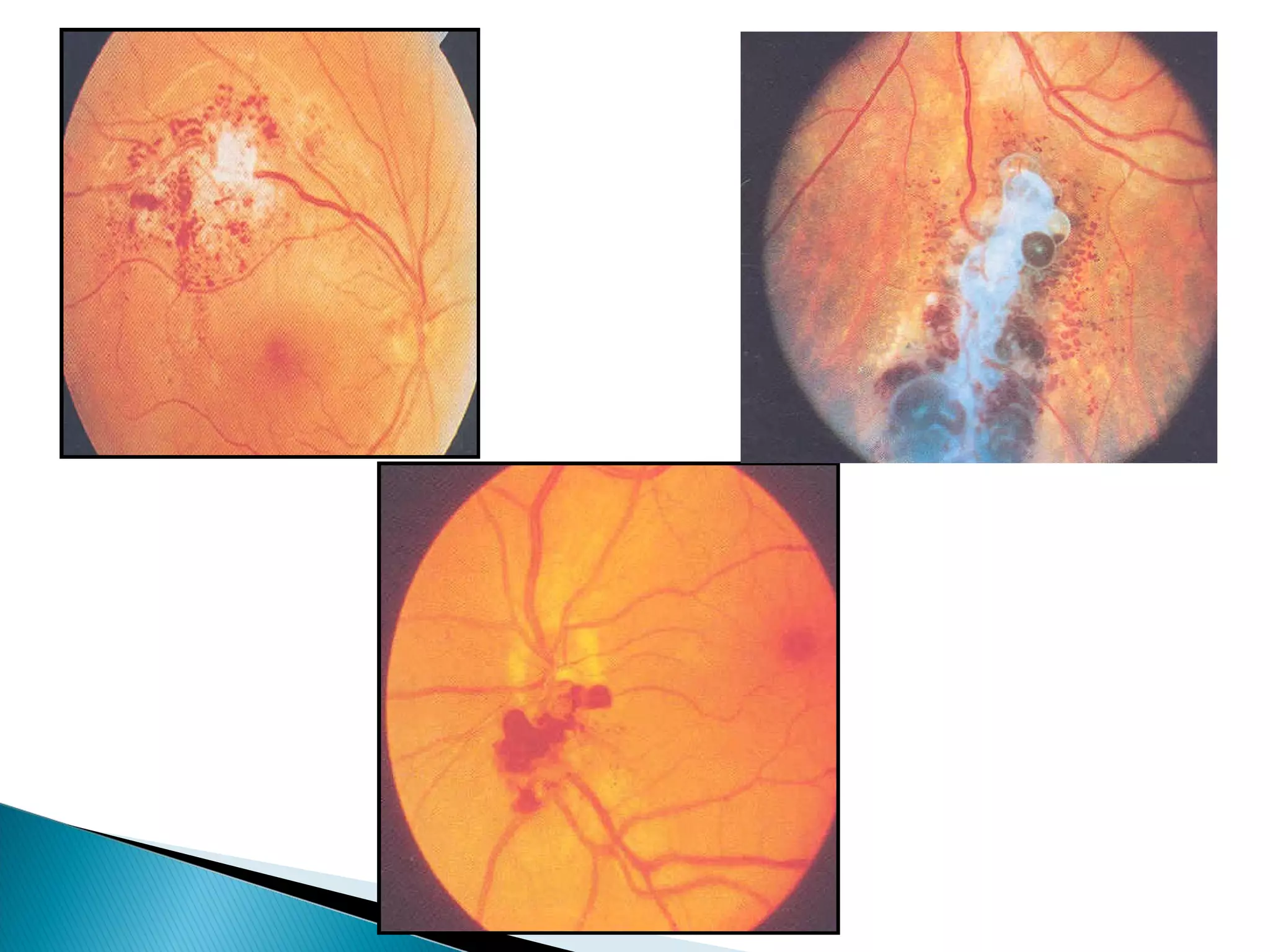Retinal lesions Pathophysiology | PPT