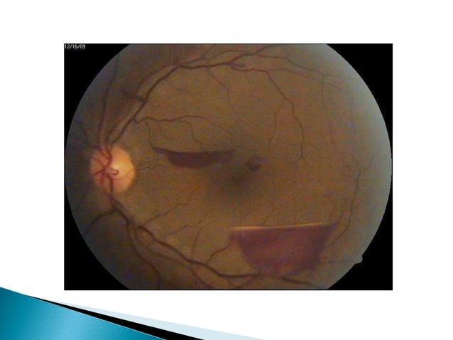 Retinal lesions Pathophysiology | PPT